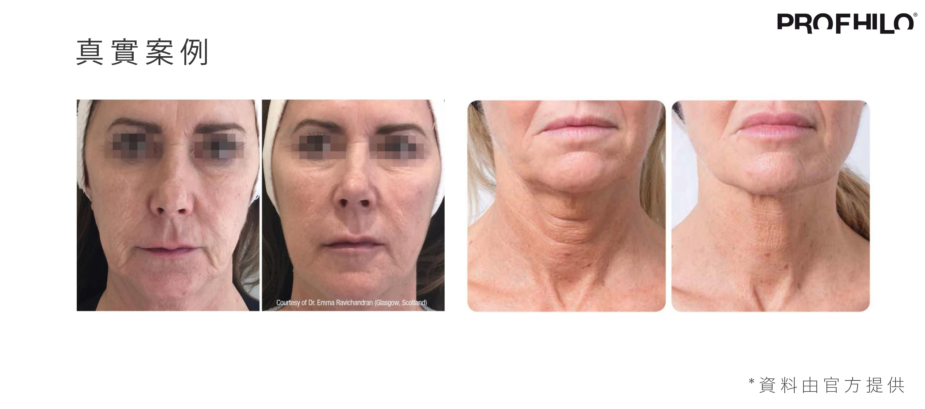 Profhilo 逆時針 | 透明質酸針 | 激活膠原逆轉肌齡 - Medskin Plus